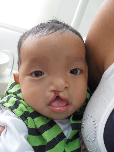 ¿Qué son el labio y paladar fisurado? – Fundación Labio y Paladar Fisurado